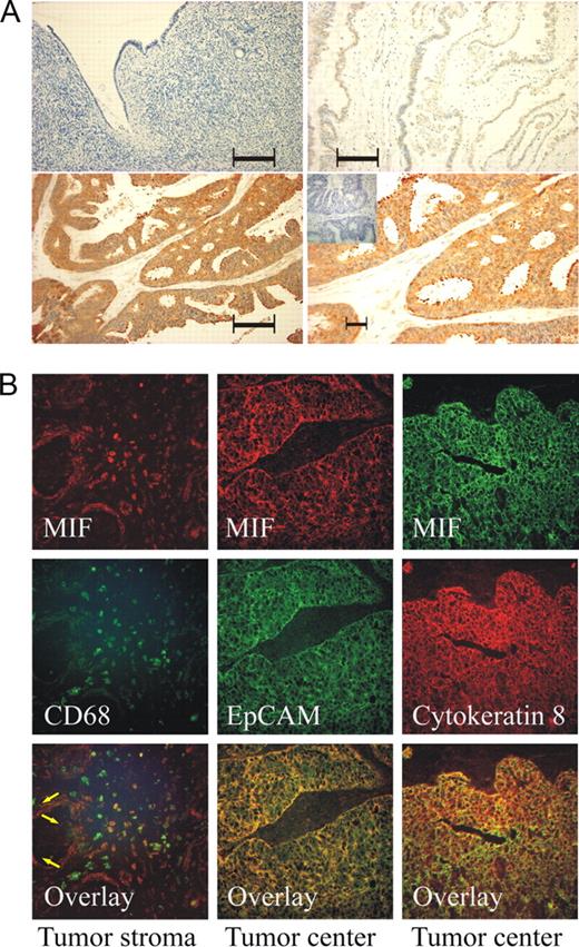 Macrophage Migration Inhibitory Factor Contributes To The Immune Escape