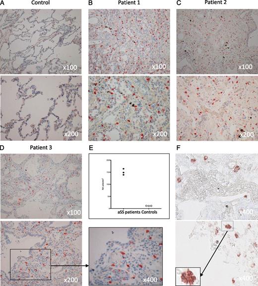 Involvement of NK Cells and NKp30 Pathway in Antisynthetase Syndrome ...